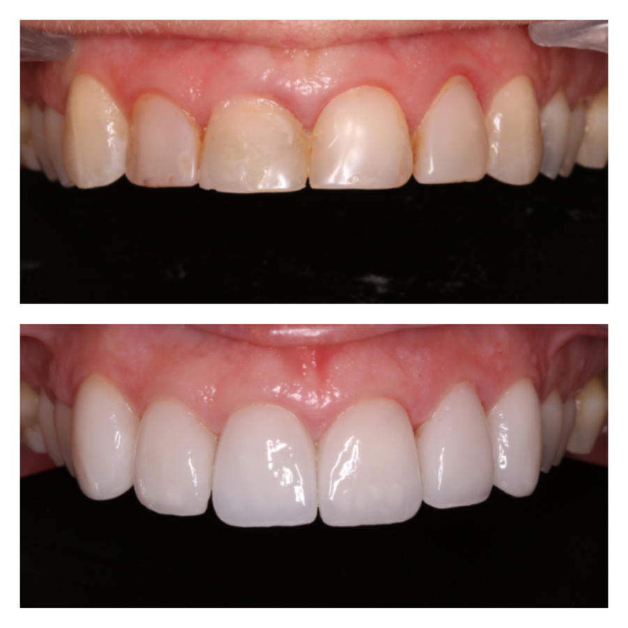 Snap-On Smile | Incredible Smiles Dental Clinic